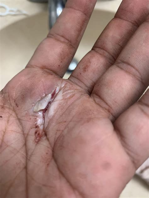 Does This Need Stitches Rmedical