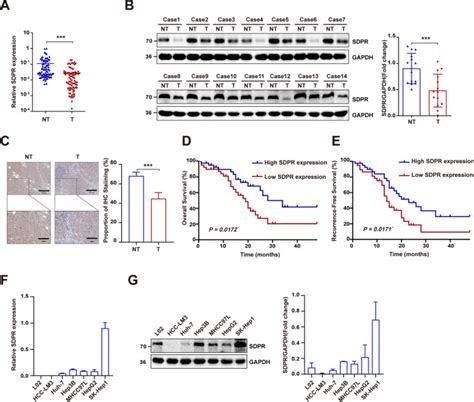 Serum Deprivation Response Protein Induces Apoptosis In Hepatocellular