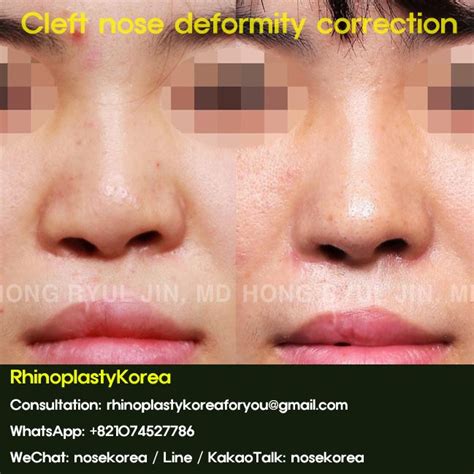This Is A Case Of Cleft Nose Seoulian Marketing