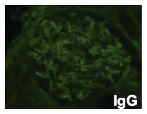 Renal Biopsy Showing Deposition Of Immunoglobulin G Igg And