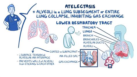 Video Atelectasis Nursing Osmosis