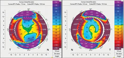 Profilometry Guided Scleral Design For Highly Toric Sclera Contact