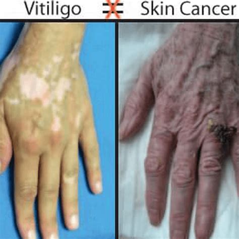 Cómo prevenir las manchas blancas en la piel provocadas por el sol