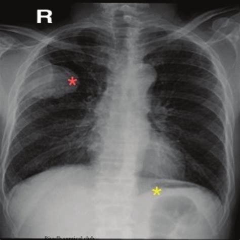 A Chest X Ray Showing Weakly Enhancing Pleural Based Mass Star