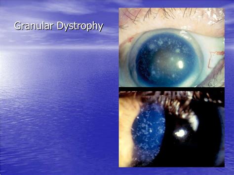 Ppt Corneal Dystrophies And Degenerations Powerpoint Presentation