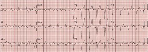 Peaked T Waves