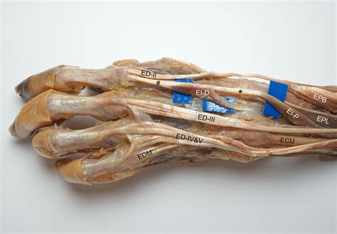An Accessory Head Of The Extensor Indicis A Rare Case Report