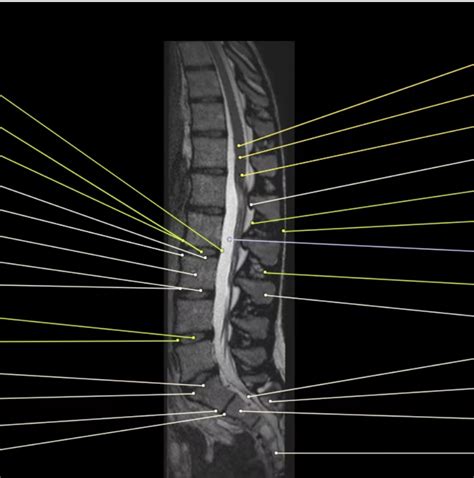 Sagittal Lumbar Anatomy Mri Normal Diagram Quizlet