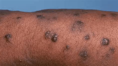Understanding Common Skin Issues Affecting Black People Nowincluded