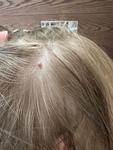 4yo Has This On Scalp Rmelanoma