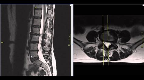 A Herniated Disc Back Surgery For A Herniated Disc Erofound