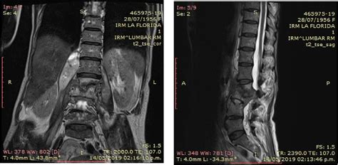Magnetic Resonance Imaging Mri Scan Of The Lumbar Spinal Showing The