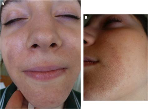 A Circular Reddish Brown Pigmentation Around The Mouth And Nose With Download Scientific