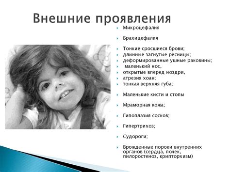 Синдром Карнелии де Ланге презентация онлайн