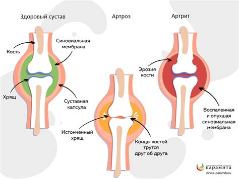 Иглоукалывание при артрозе и артрите - чем полезна методика