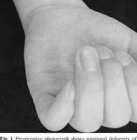 Figure 1 From Reduction For The 5 Th Metacarpal Neck Fracture Semantic Scholar