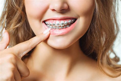 First Week With Braces Comfort Tips In Ann Arbor Mi