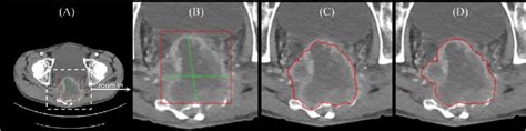 Example Of Automatic Lesion Segmentation With Weakly Supervised