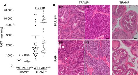 Proteaseactivated Receptor1 Impedes Prostate And Intestinal Tumor