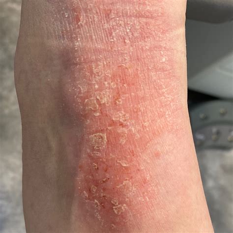 Ekzem ICD 10 L20 L30 Online AI Dermatologist