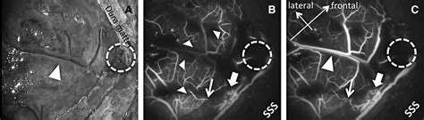 Intraoperative Photograph A The Early B And Late C Phase Of The