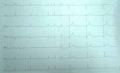 Cardiology Window Ecg Sinus Node Dysfunction