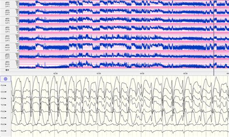 The Aeeg Of The 2 Day Old Patient The Aeeg Showed A Continuous Normal Download Scientific