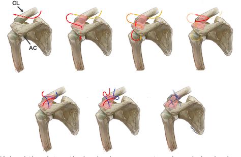 Figure 1 From Reconstruction Of The Acromioclavicular Joint Using A
