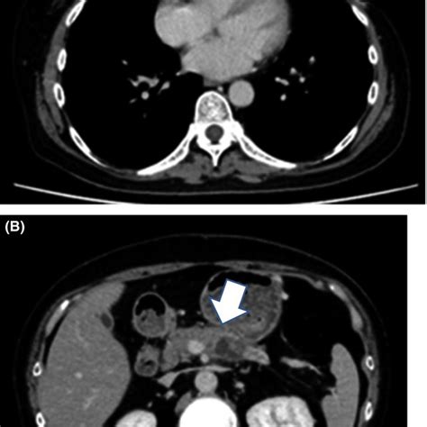 Intrapancreatic Lipoma Axial Ct Showing A Fat Density Lesion In The
