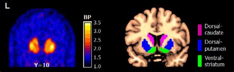 PDF Asymmetry Of Dopamine D2 3 Receptor Availability In Dorsal