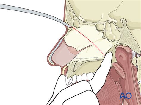 Le Fort Ii Osteotomy For Bilateral Cleft Lip And Or Palate