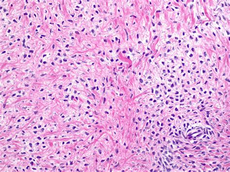 Irritation Fibroma Histology