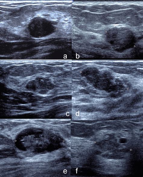 Nódulo Hipoecogênico No útero Retoedu