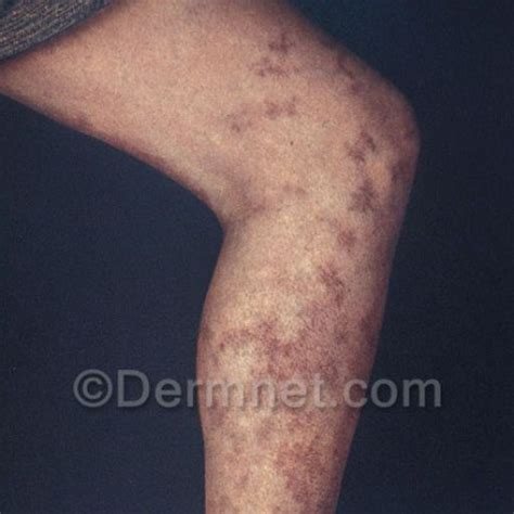 Soebskin Disease Vasculitis Generator · Hugging Face
