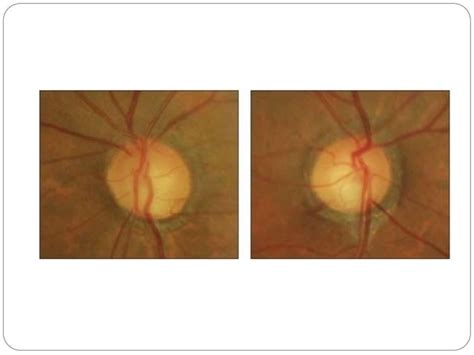 Normal Tension Glaucoma Pptx