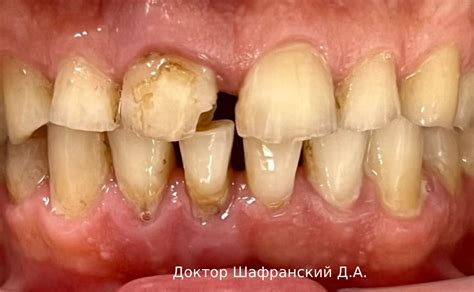 Трещины зубов решение проблемы от клиники эстетической стоматологии Просмайл Ру