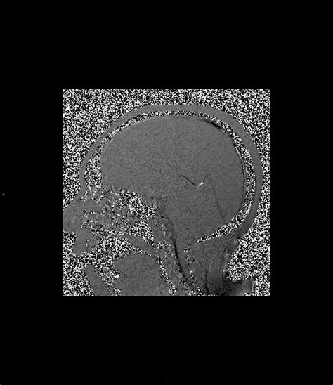 Giant Tumefactive Perivascular Spaces A Rare Cause Of Cognitive