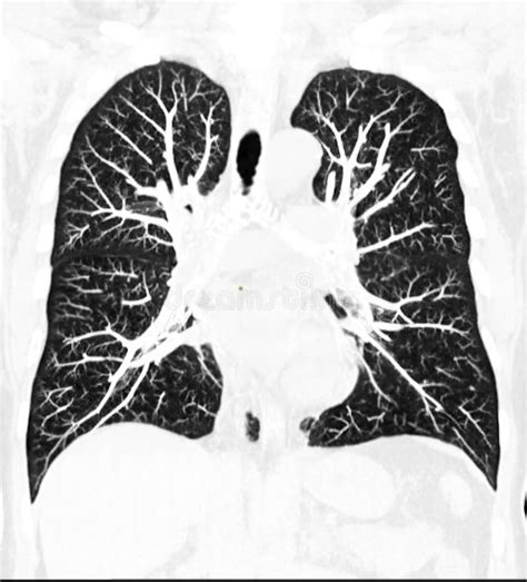 Ct Chest Scan Overview Shows Clear Lung Fields Heart And Mediastinum Providing A Detailed