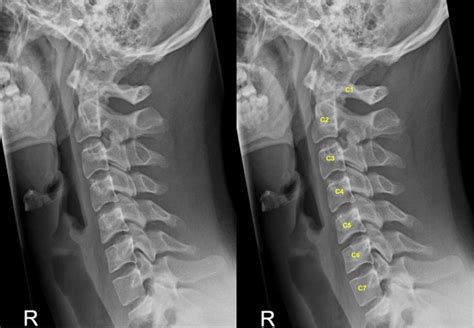 My Approach To Clearing C Spines Canadiem