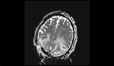Posterior Reversible Encephalopathy Syndrome Pres Radiology Article