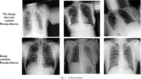 Figure 1 From Xception Model For Pneumothorax Classification Using Chest X Ray Images Semantic