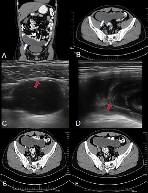 Frontiers The Value Of Ultrasound Combined With Ct In Identifying Early Low Grade Appendiceal