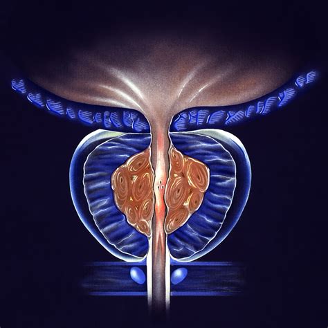The Rezum® Procedure Performed At Z Urology Z Urology