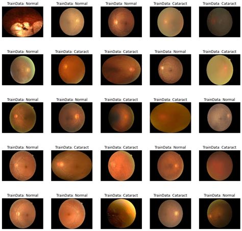 Cataract Detection Using Machine Learning Tpoint Tech