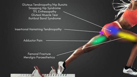 Hip Pain Location Diagram Hip Pain Location Chart