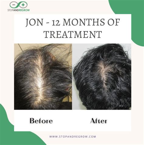 Stop And Regrow On Linkedin Hairgrowth Hair Hairloss Hairstyle