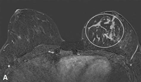 Idiopathic Granulomatous Mastitis Eurorad