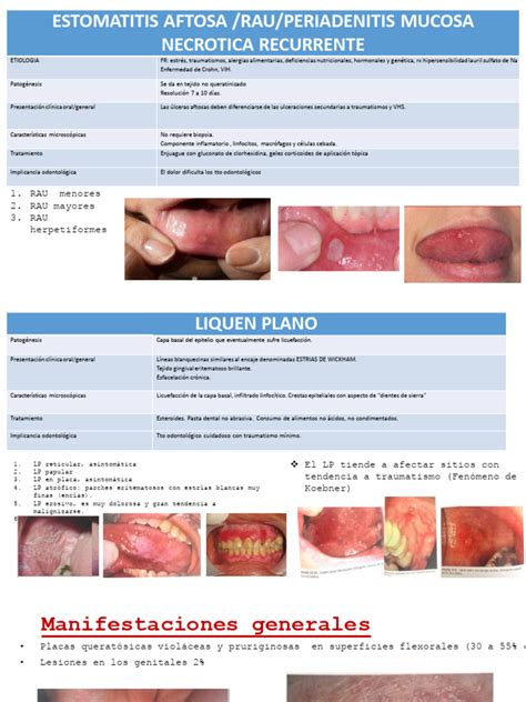 Estomatitis Aftosa Rauperiadenitis Mucosa Necrotica Recurrente Pdf