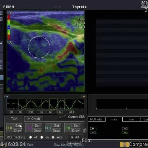 Illustrates Cystic Lesion With Mural Nodule The Mural Nodule Has A Download Scientific Diagram