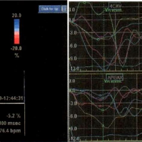 Global Longitudinal Lv Strain Showing A Global And Segmental